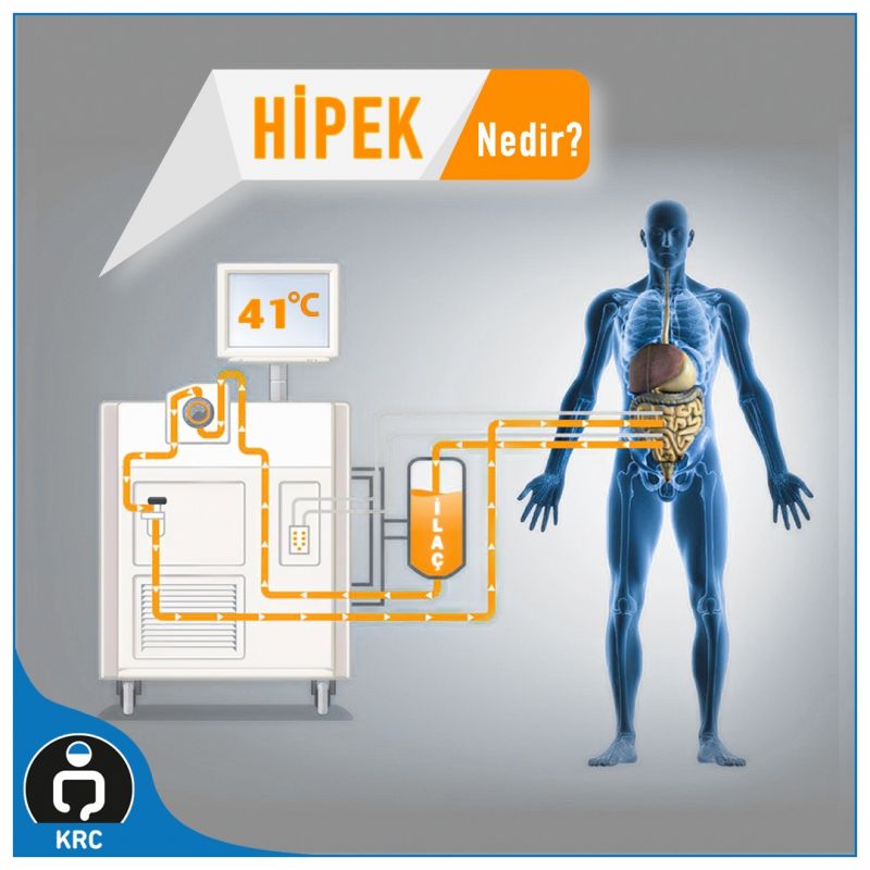 Hipek Nedir ? | Kolorektal Cerrahi İzmir